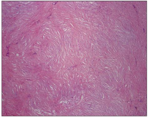 Storiform Pattern In Dermatopathology Indian Journal Of Dermatology Venereology And Leprology
