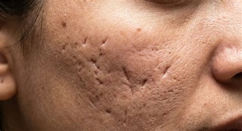 Understanding Acne Scars Causes Types And Professional Management