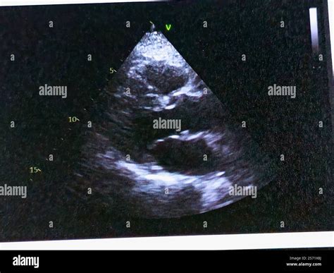 Echocardiography Or Cardiac Ultrasound Shows Normal Values Except For