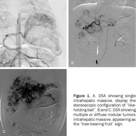 Figure 1 From Interventional Embolization In Treatment Of Infantile