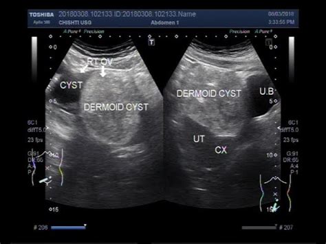 Dermoid Ovarian Cyst Ultrasound