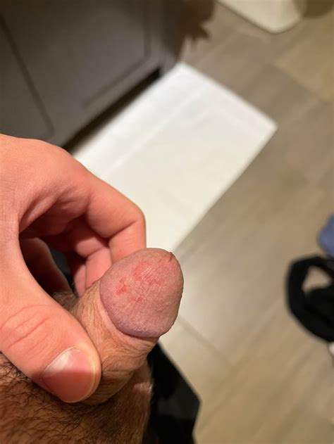 Red Patches On Tip Of Penis More Info In The Pictures Please Help