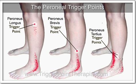 Fibularis Longus Trigger Point Peroneus Longus And Brevis Self Trigger