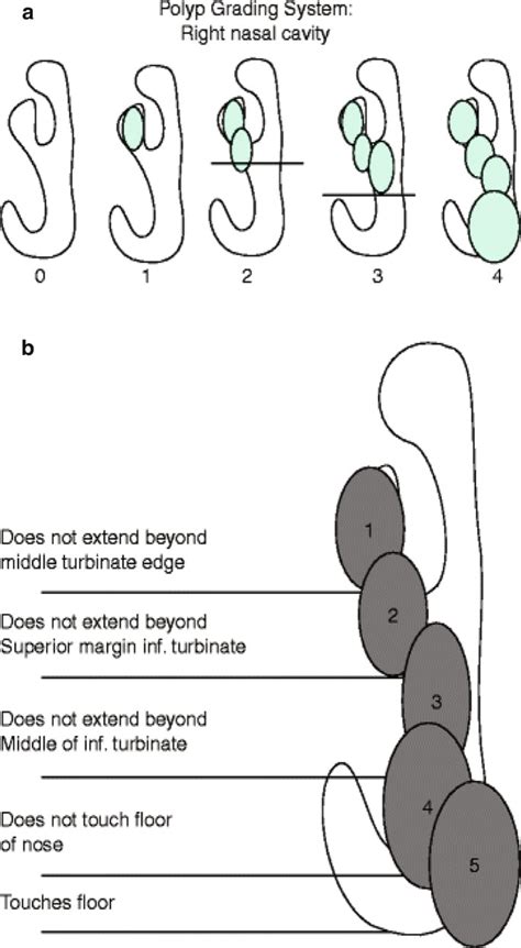 Categorization Of Nasal Polyps Springerlink