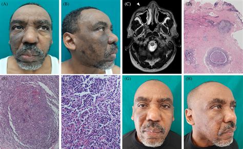 Zygomatic Abscess Symptoms At Alex Wright Blog