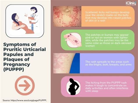 Pruritic Papular Eruption Of Pregnancy
