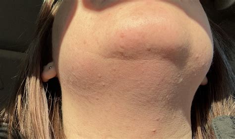 Does This Look Like Urticaria Rurticaria