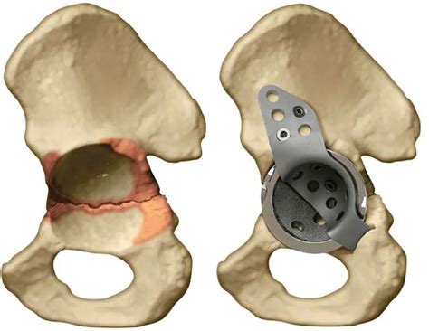 Acetabular Bone Loss With Chronic Pelvic Discontinuity Acetabular Cup