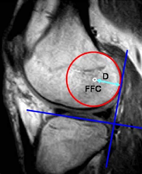 Measurement Of Distance D From A Flexion Facet Centre Ffc To The