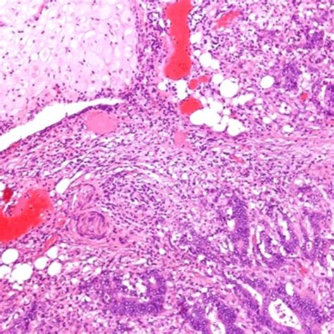 The Mucus Of Caliciform Cells In Normal Tissue Is Colored In Intense Download Scientific