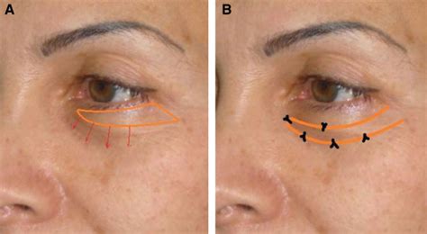 Correction Of A Hollow Lower Eyelid With Hypertrophy Of The Pretarsal Portion Of The Orbicularis