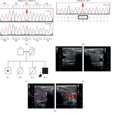 Figure 1 From A Novel Homozygous Mutation Of Thyroid Peroxidase Gene
