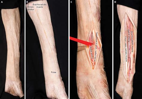 Extracranial Intracranial Bypass With Interposition Graft Neupsy Key
