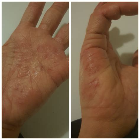 Dyshidrotic Eczema Crohns Disease At Nicole Webber Blog