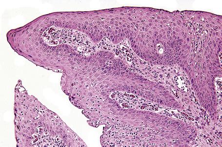 Tumors Of The Conjunctiva Basicmedical Key