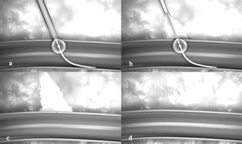 Safety And Efficacy Of Percutaneous Femoral Artery Access Followed By