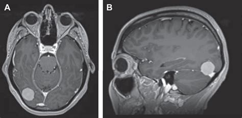 Incidental Meningiomas Neurosurgery Clinics