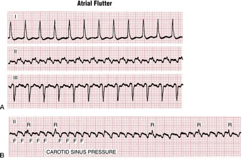 Supraventricular Arrhythmias Part Ii Atrial Flutter And Atrial Fibrillation Thoracic Key