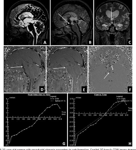 Figure 2 From Assessment Of Third Ventriculostomy Patency With The 3d