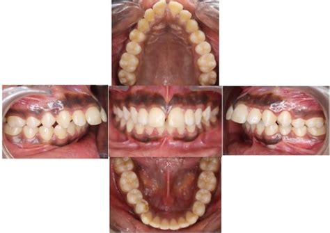 Improving Occlusion And Function With Acrylic Splint Herbst A Case
