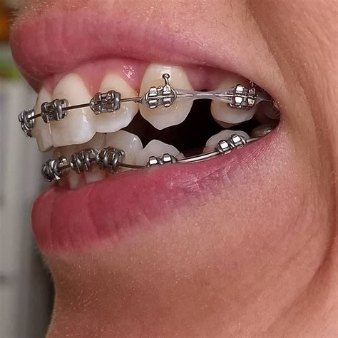 Cute Braces Colors Power Chain Warehouse Of Ideas