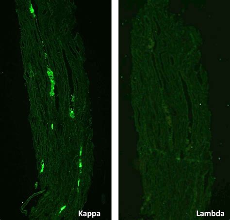 Pathology Outlines Kappa And Lambda Light Chains