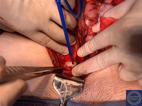 The Colpotomy Was Approached Anteriorly Using A Circumferential