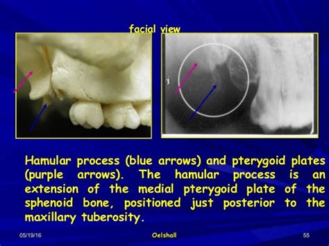 Hamular Process
