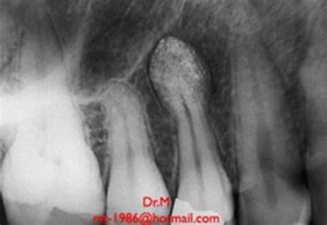 Oral Path Pt3 Flashcards Quizlet
