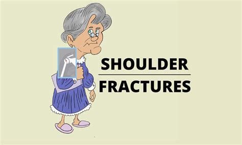 Shoulder Fractures And Their Treatment Pro Doctor