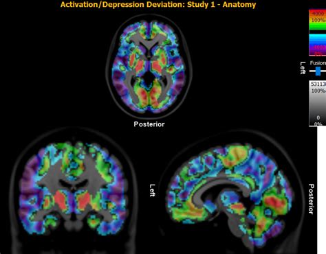 Hermia Centiloid Scale Hermes Medical Solutions