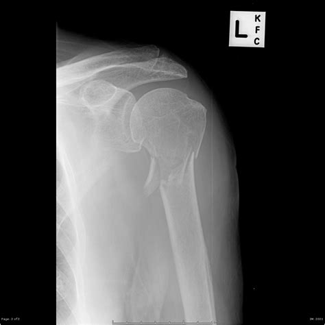 Bones Of The Upper Limb Geeky Medics