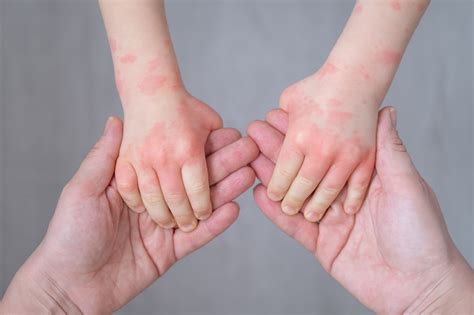 Jeffrey Cizenski Md Faad Eczema Representation Through Under My Skin