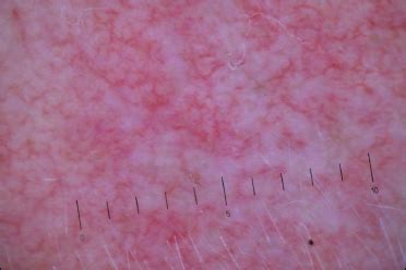 Treatment Of Spider Angioma With Copper Vapour Laser Radiation 578 Nm