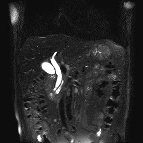Abdomen Magnetic Resonance Imaging Findings It Shows Common Bile Duct