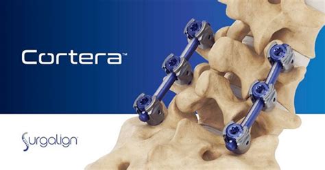 Surgalign Announces 100th Case Completed Utilizing Its Recently