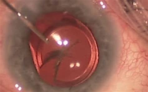 Crstg Europe Edition Late Calcification Of Iols