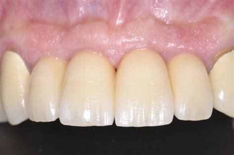 Ridge Preservation With Maxgraft® Mucoderm® And Jason® Membrane Dr F Rojas Vizcaya