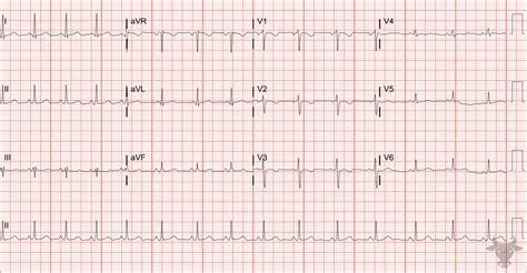 Persistent Juvenile T Wave Pattern Ecg Stampede