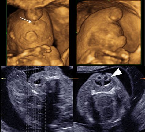 Neurosonoembryology By Three Dimensional Ultrasound Seminars In Fetal