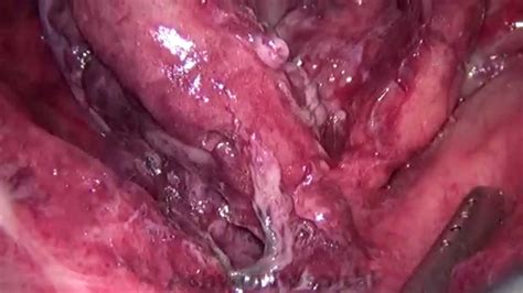Laparoscopic Appendectomy Difficult Case Appendicular Abscess Youtube