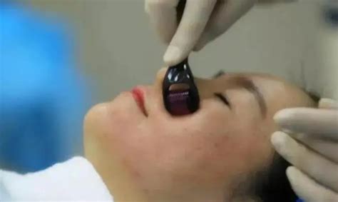 How To Take Care Of Your Skin After Derma Rolling Xdermaroller