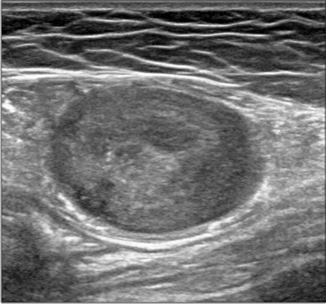 The Ultrasonographic Finding Shows Well Defined Heterogenous Echogenic