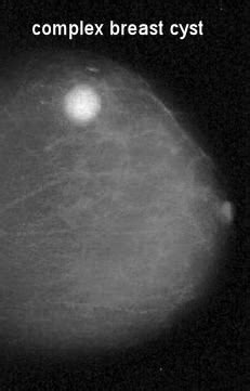 A Complex Cyst Of The Breast Moose And Doc