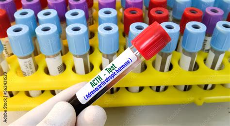 Blood Sample For Adrenocorticotropic Hormone Acth Test Diagnosis Of