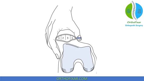 Patellar Glide Test Explained Easily Orthofixar