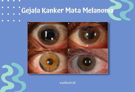 5 Tahap Diagnosis Kanker Mata Melanoma Mematikan