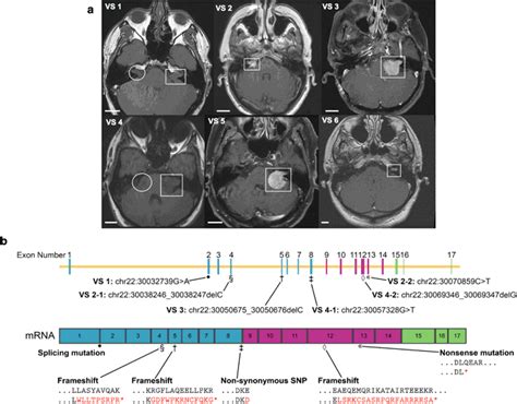 Tumor Size And Nf2 Mutation Type Show No Relationship With Response