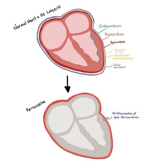 Pericarditis — When The Beat Drops A Residents Guide To The Ccu
