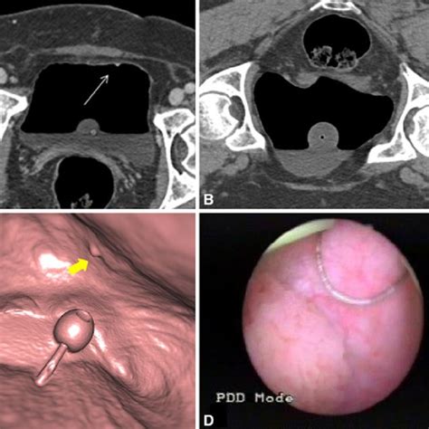 A 66 Year Old Woman With A Polypoid Lesion On The Anterior Wall Of The Download Scientific